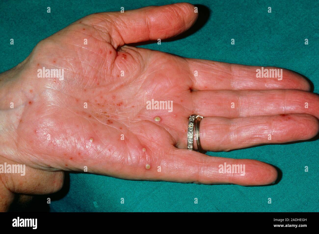 Discoid eczema. Close-up of the hand of a patient suffering from ...