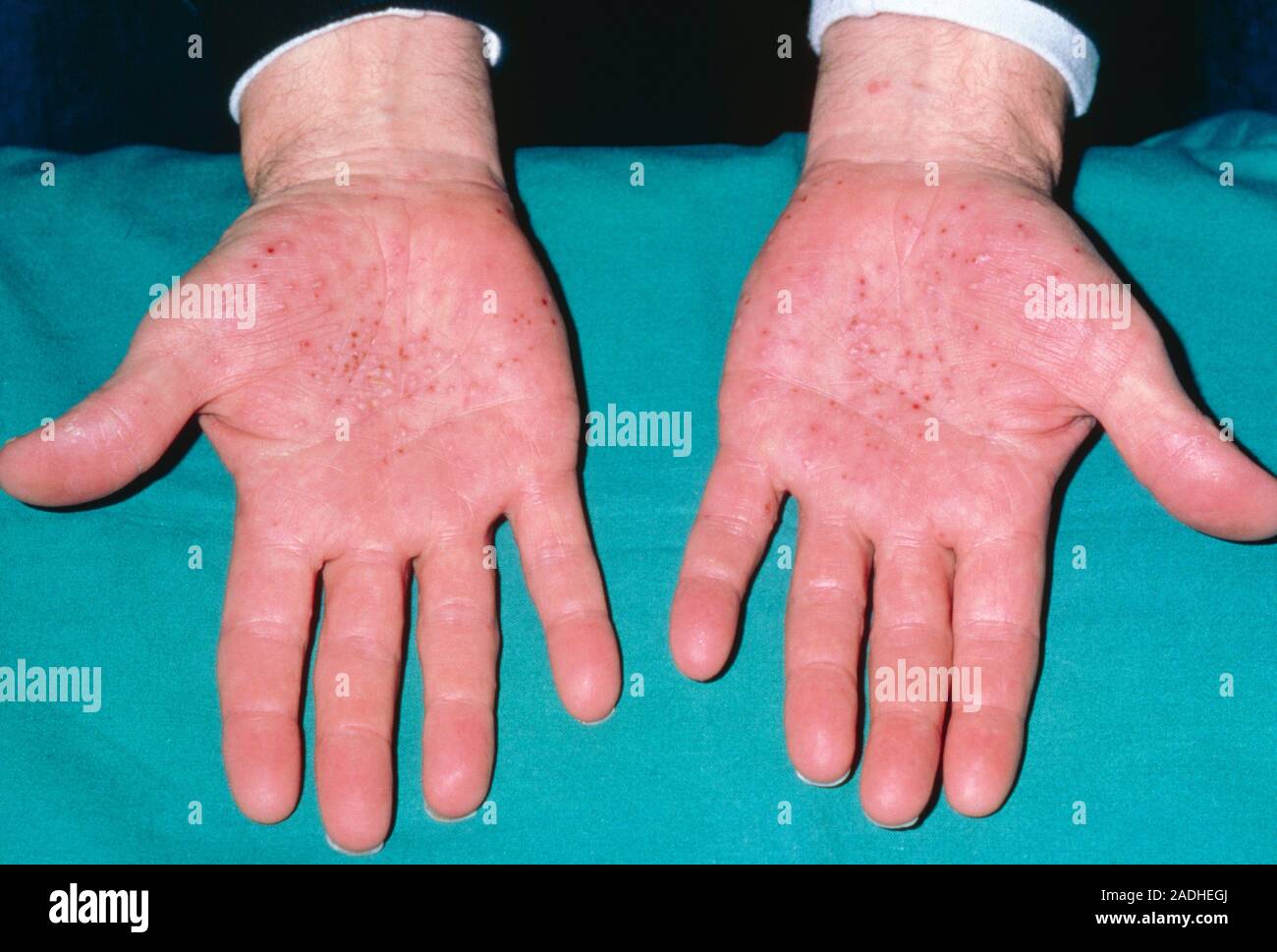 Discoid eczema. Close-up of the hands of a patient suffering from ...