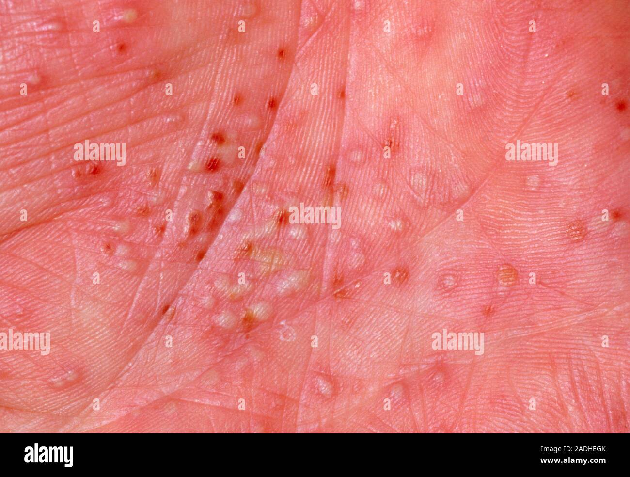 Eczema. Close-up of the palm of a patient suffering from eczema. Eczema ...
