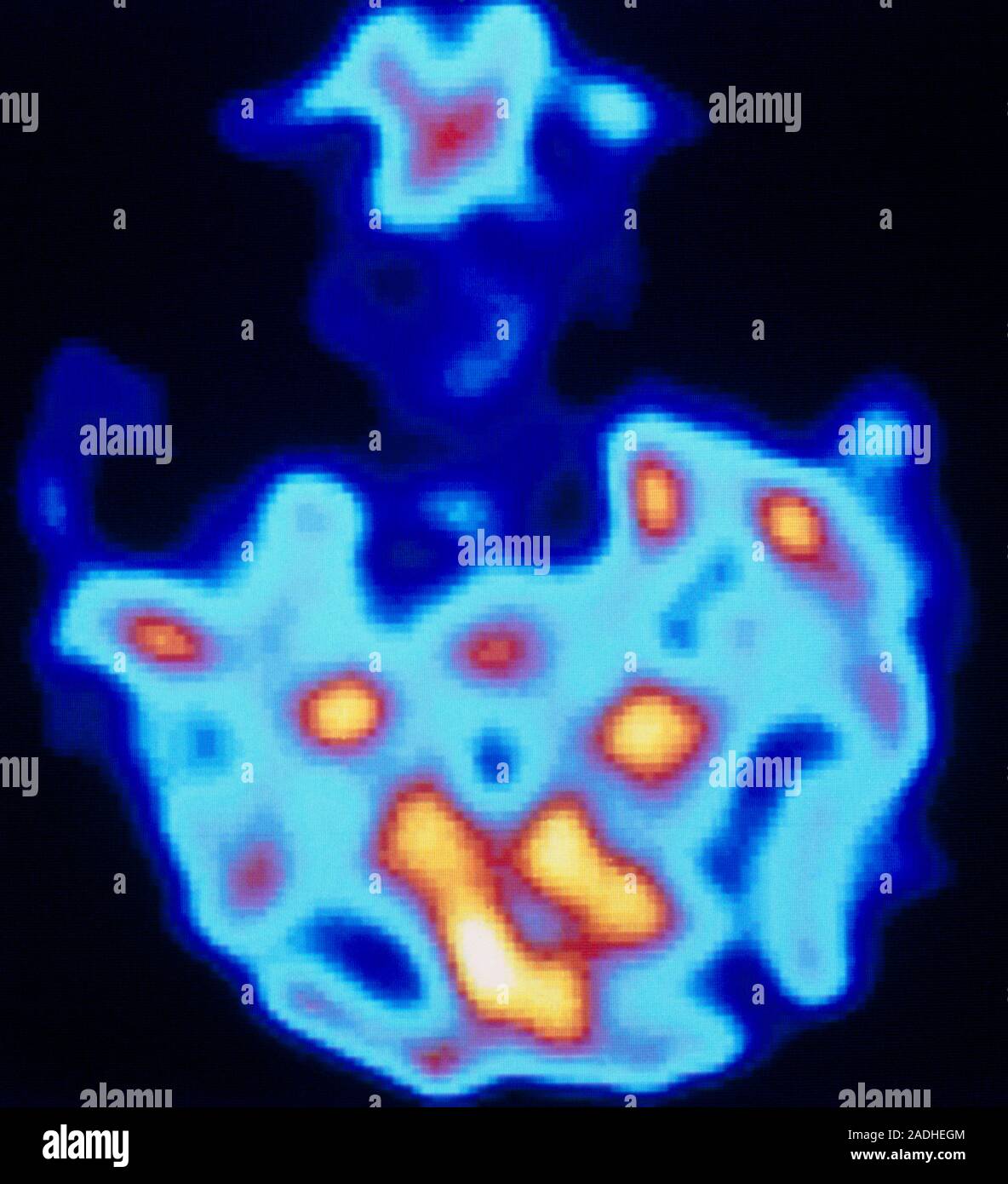 Positron emission tomography (PET) scan of the brain (temporal plane ...