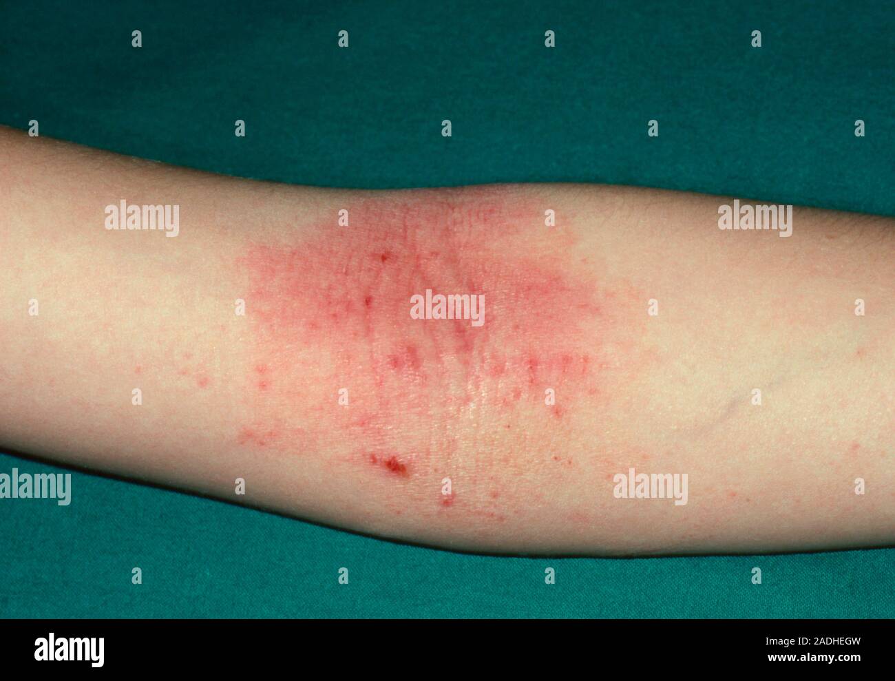 Skin disorder. The elbow of a patient affected by atopic eczema. This ...