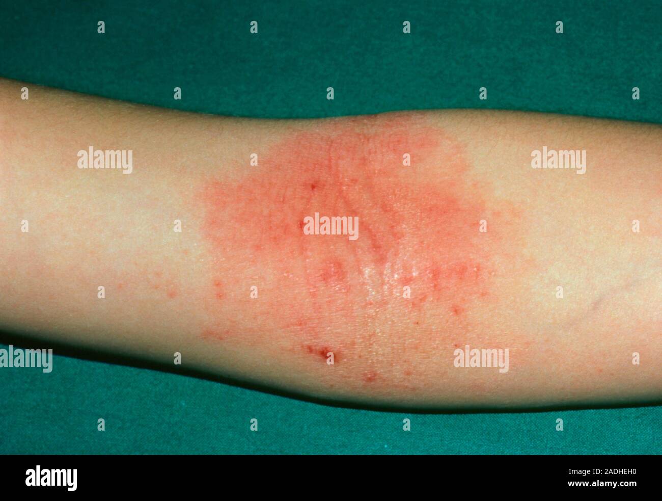 Skin disorder. The elbow of a patient affected by atopic eczema. This ...