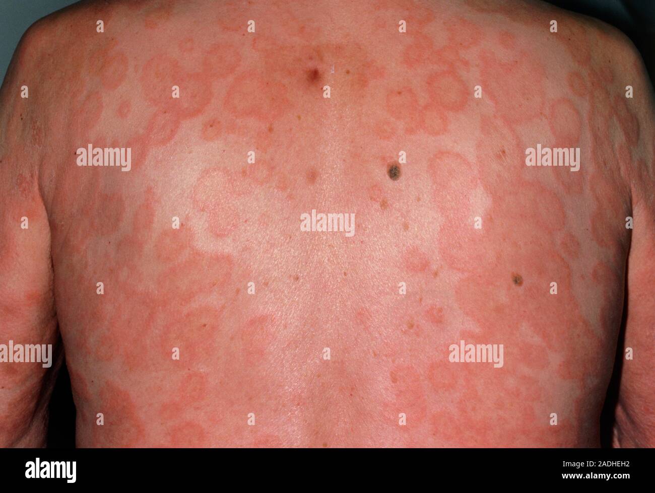 Erythema multiforme. View of an acute skin rash covering the back of a ...
