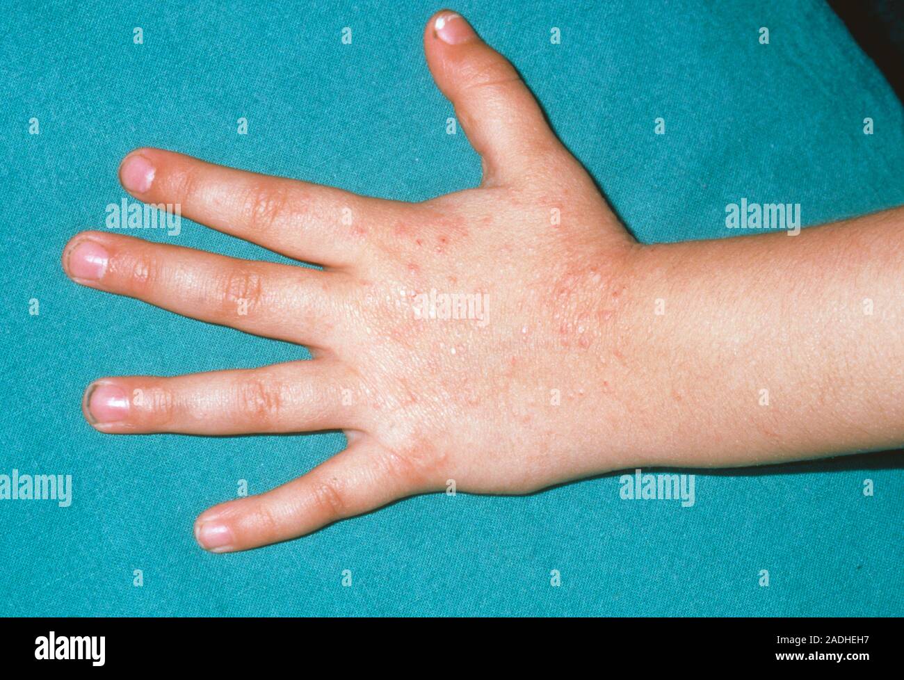Eczema from cat allergy. This child's left hand is covered with small ...