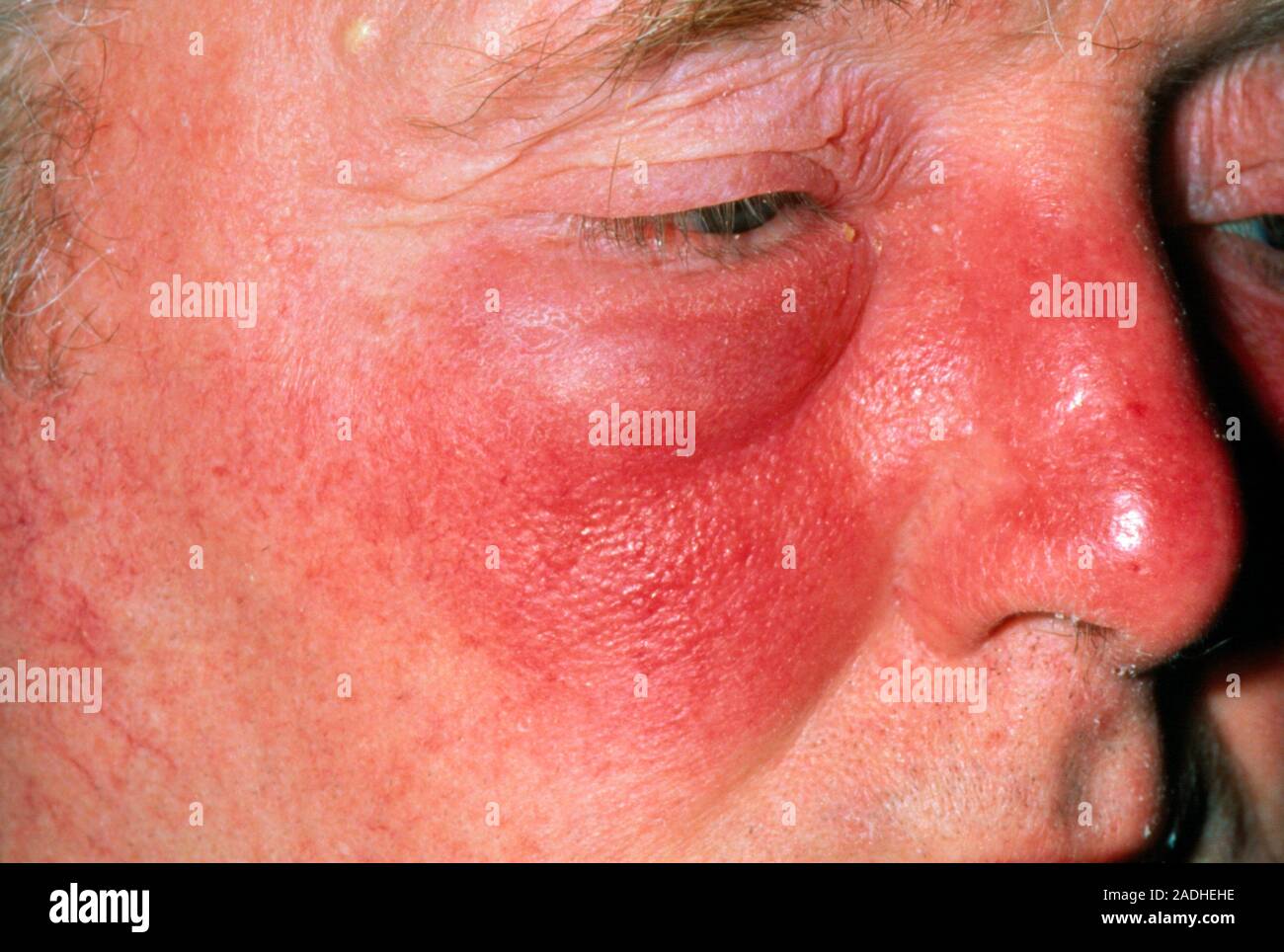 Erysipelas on face. Close-up of swollen & inflamed skin across the nose ...