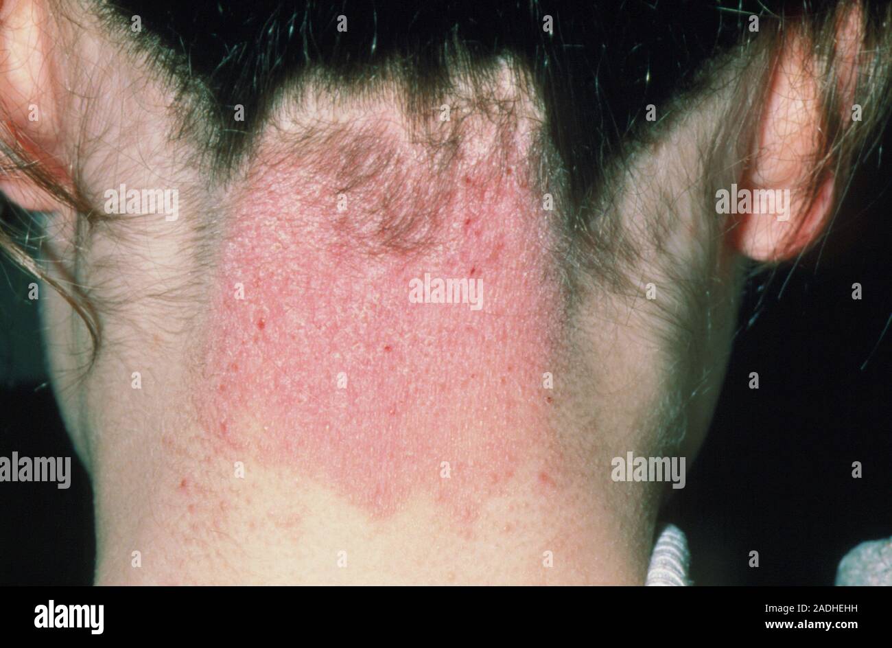 Eczema on nape of the neck. View of a patch of eczema on the back (nape ...