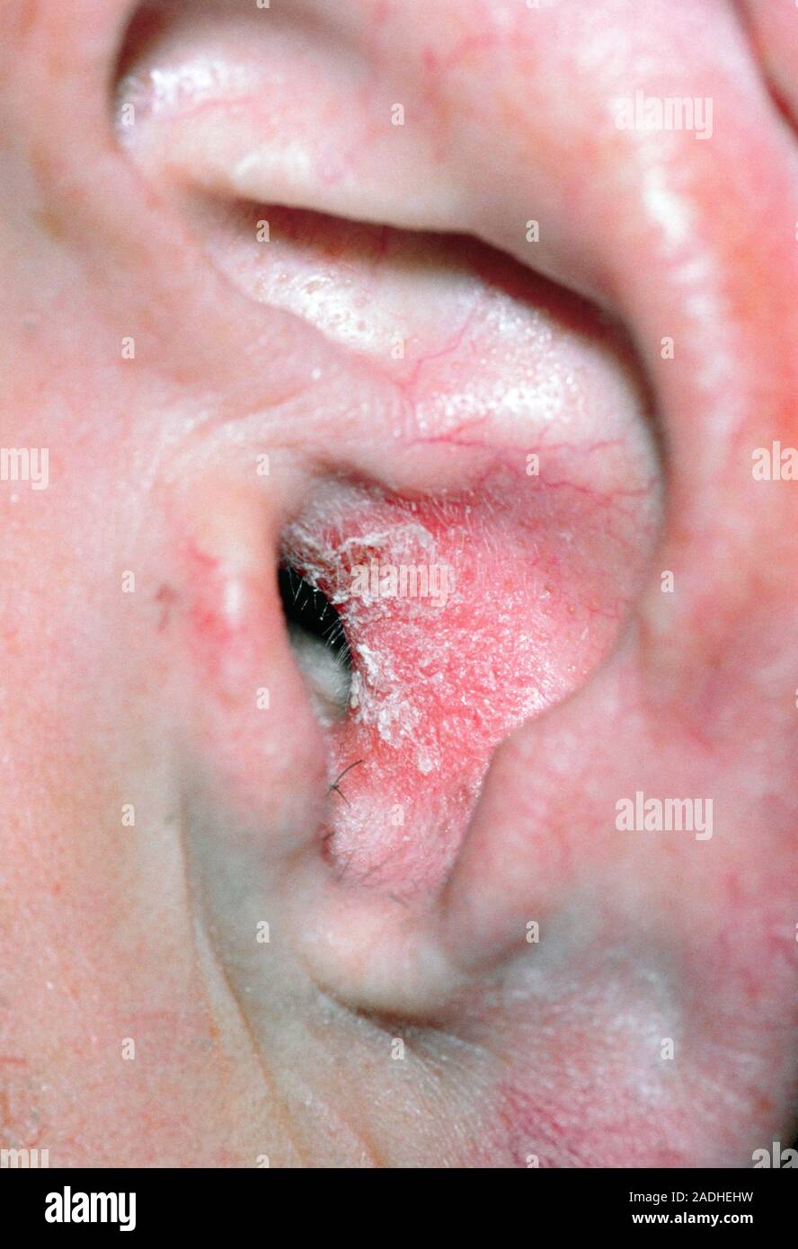 Eczema in the ear canal. The skin is red with yellowy white scaly patches. Eczema is an inflammation of the skin accompanied by itching and scaling o Stock Photo Alamy