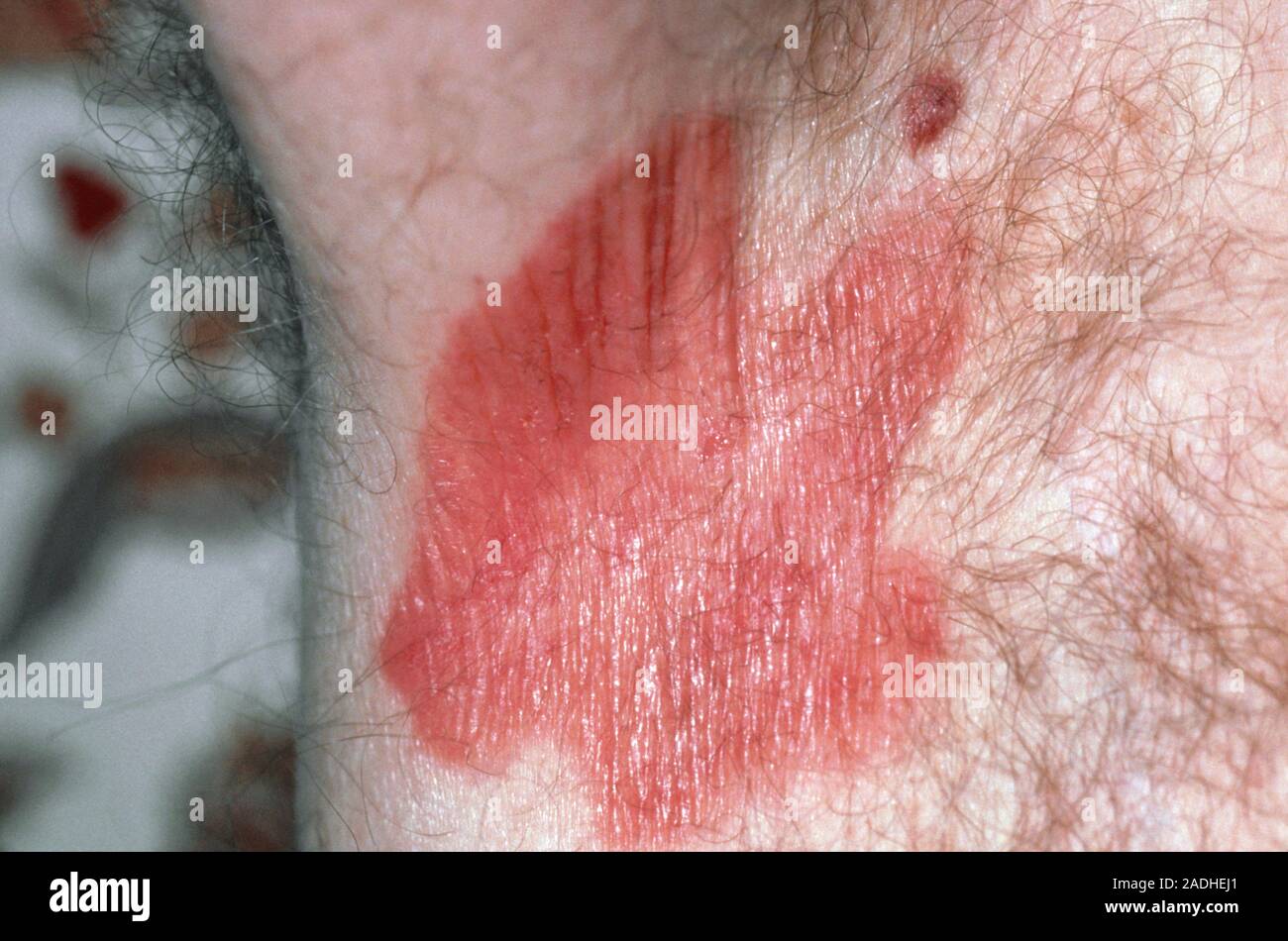 Erythrasma. Close-up of a red patch of skin in a man's armpit caused by ...