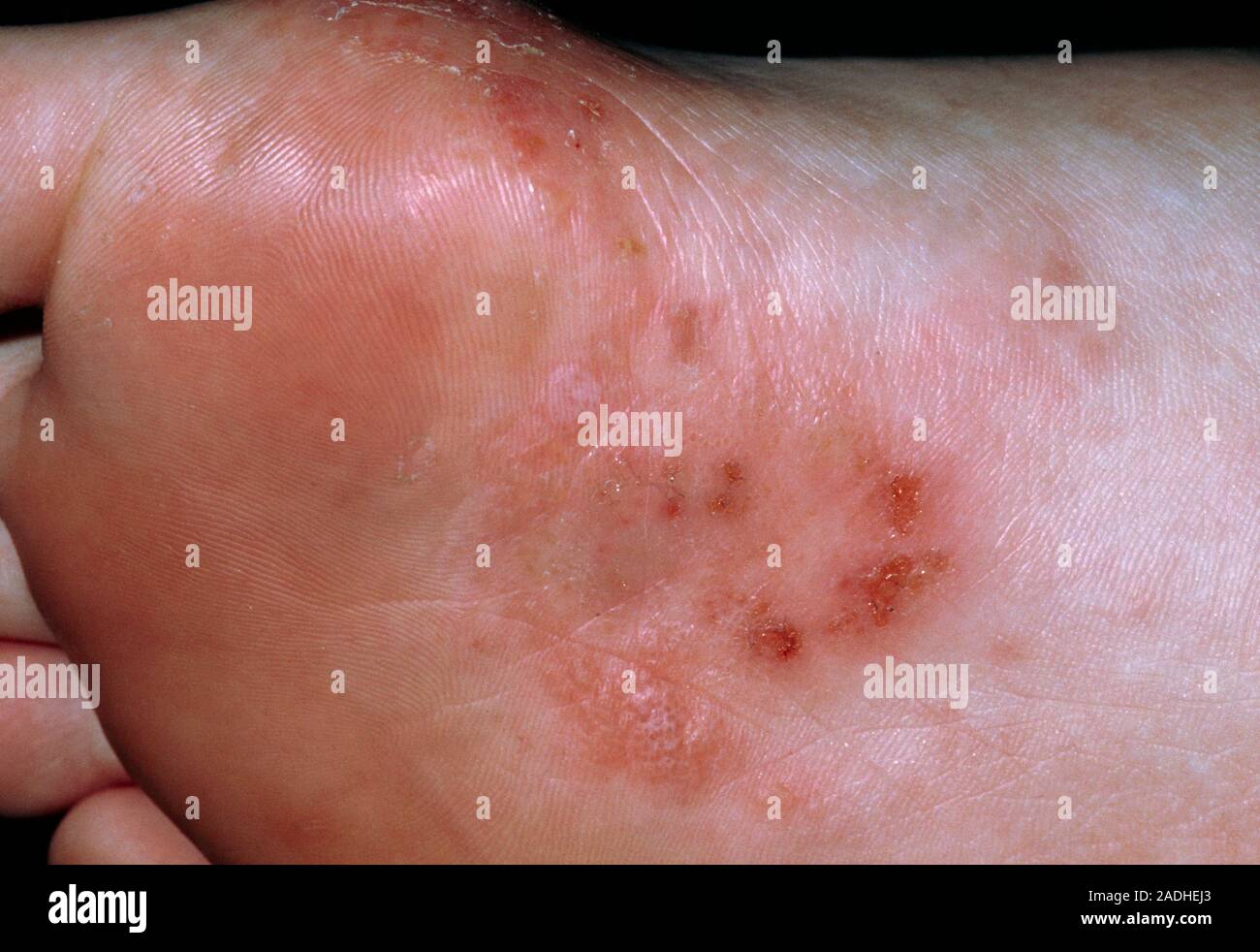 Skin disorder. The sole of a foot affected by a mild form of pompholyx ...
