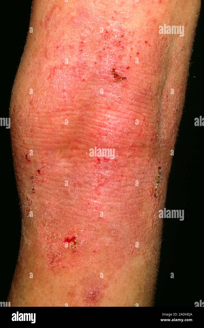Eczema. View of a patchy red eczema rash seen on the back of a 12 year ...