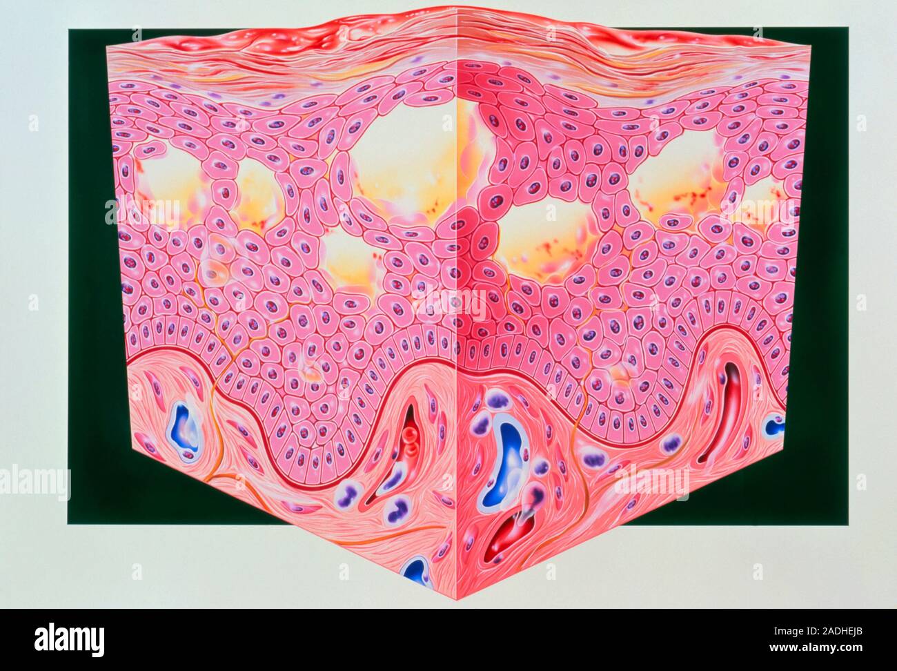 Eczema. Artwork depicting a section through the epidermis of human skin ...