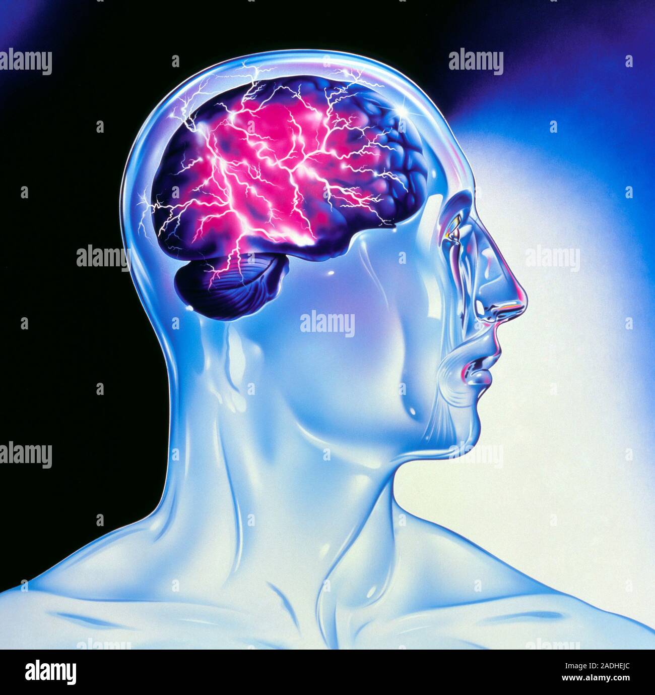 Epilepsy. Artwork depicting an epileptic attack (or seizure) as ...