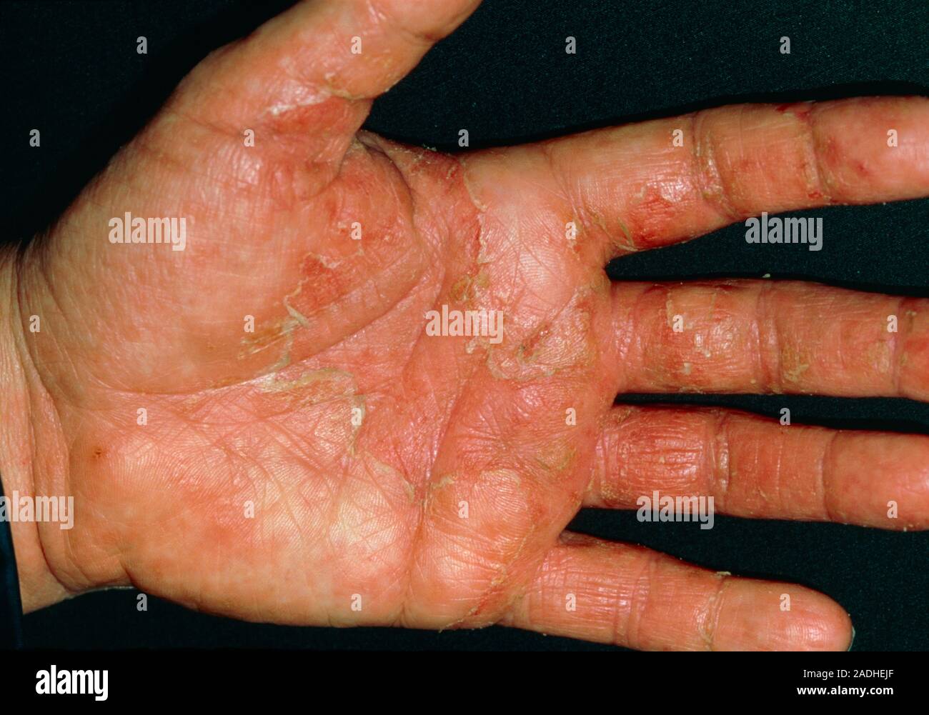 Discoid eczema. Close-up of the hand of a 59 year- old male patient ...