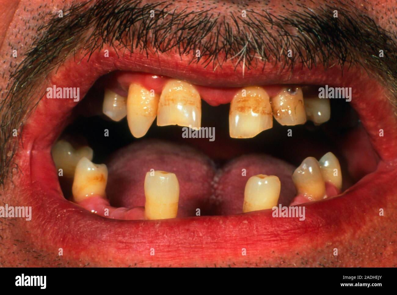 Ectodermal dysplasia dentition. View of the teeth of an adult male with ...