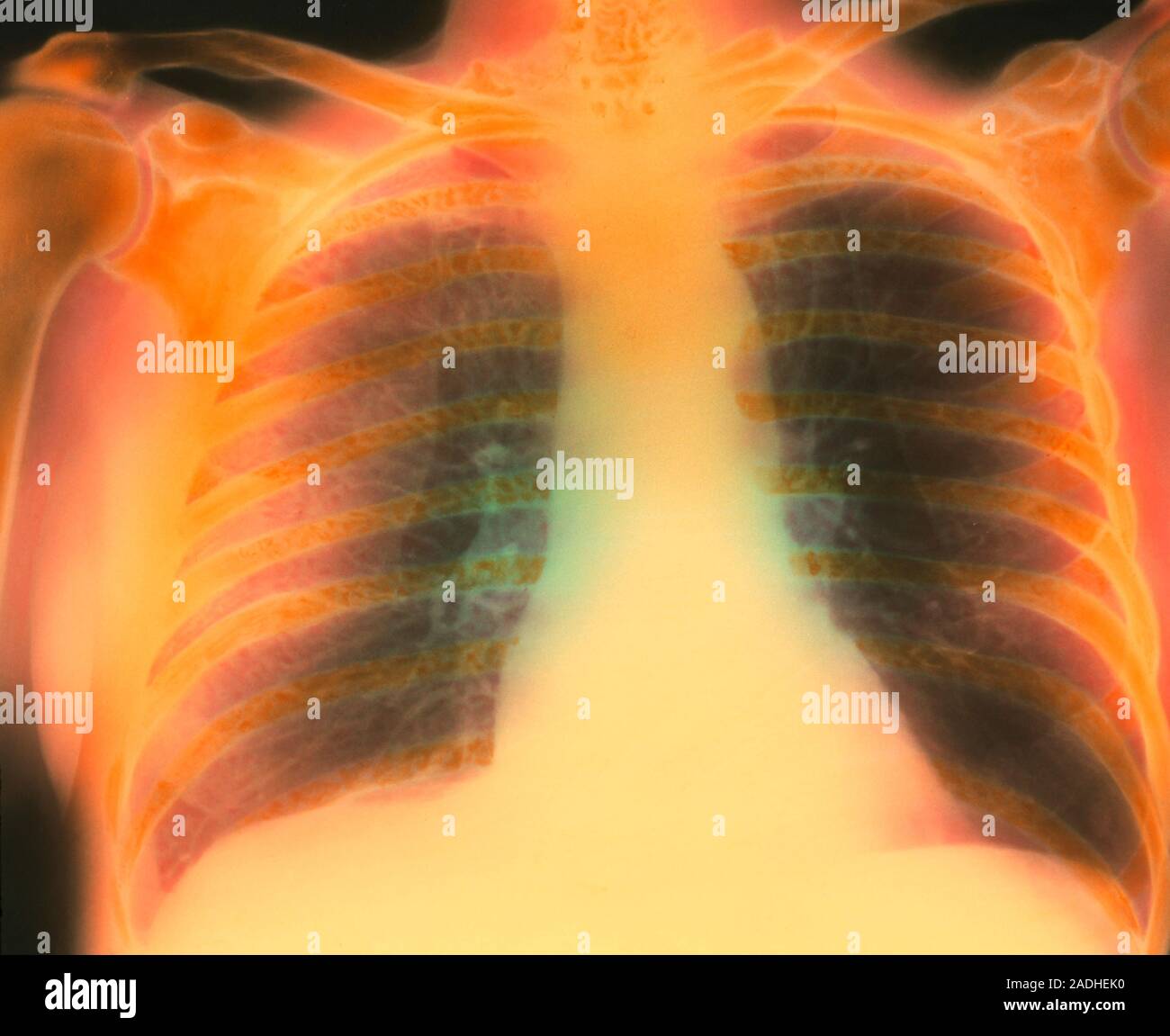 Pulmonary emphysema. Chest X-ray showing emphysema of the lungs. The ...