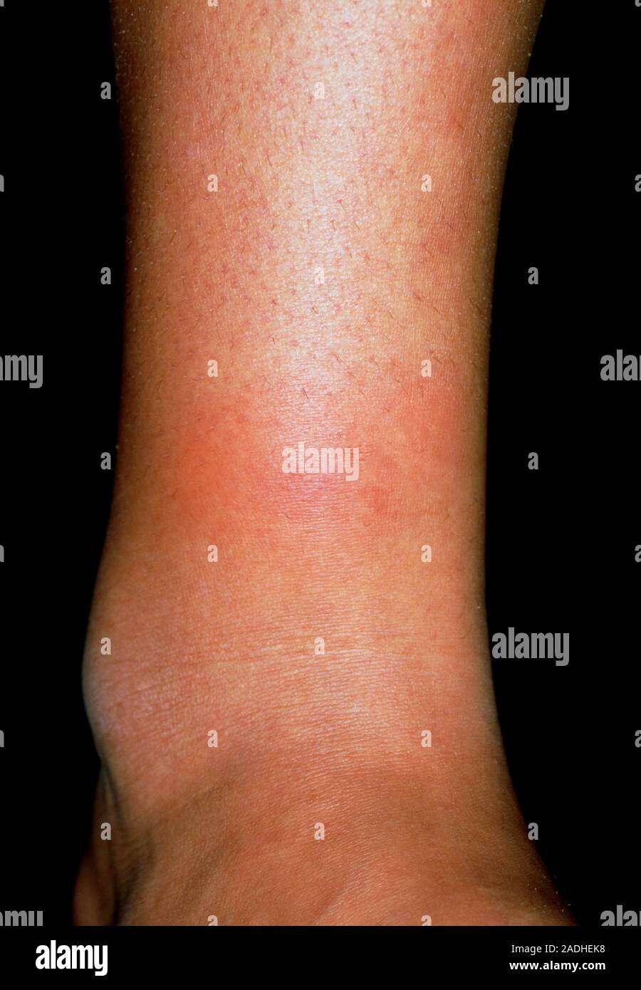Swollen leg. Erythema nodosum (red swelling) on the leg of a 10-year ...