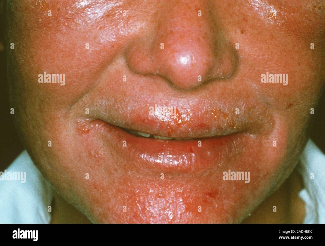 Acute eczema. Itchy skin inflammation (erythema) and blistering on the ...