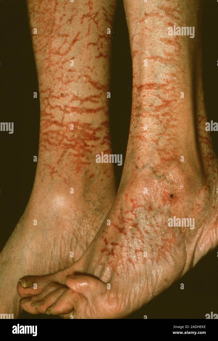 Asteatotic Eczema Dry And Cracked Skin On The Legs Of An Elderly Patient With Asteatotic Eczema
