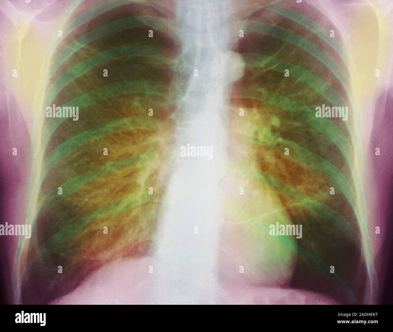 Pulmonary emphysema. Coloured chest X-ray showing emphysema of the ...