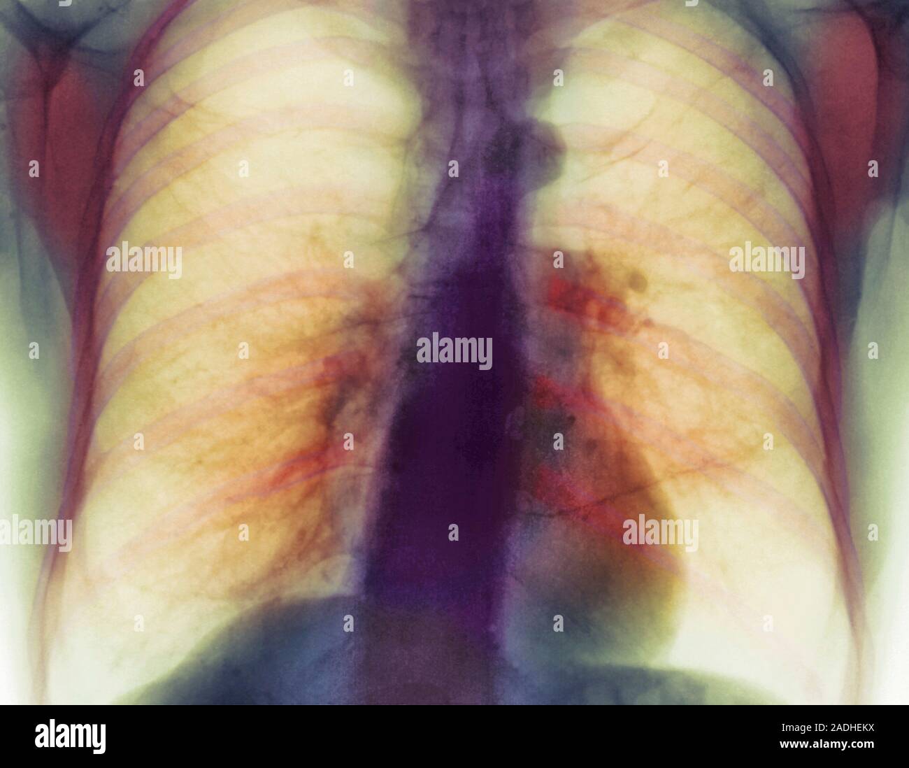 Pulmonary emphysema. Coloured chest X-ray showing emphysema of the ...