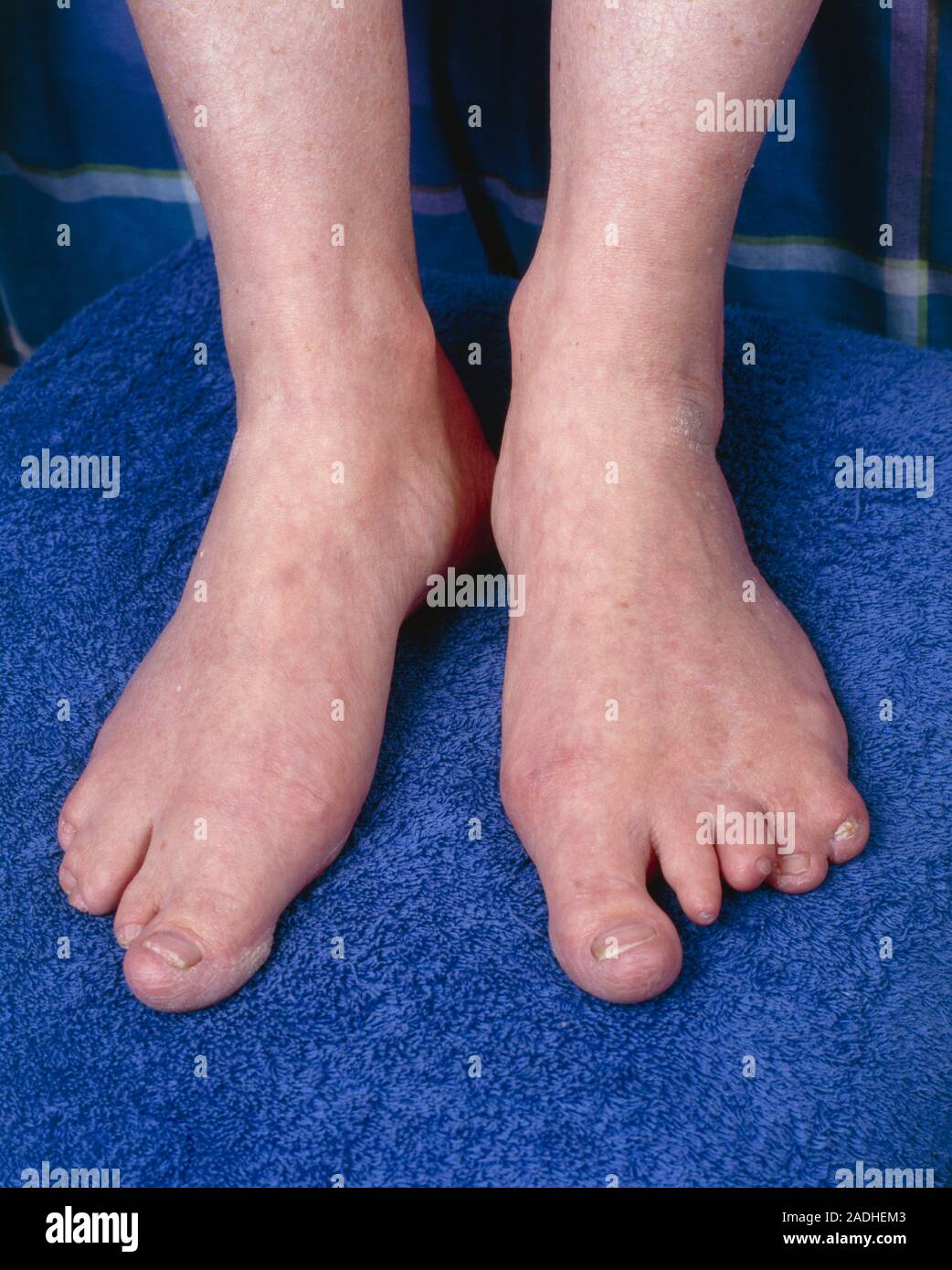 Ectodermal dysplasia. Feet showing ectrodactyly, absence of all or part ...