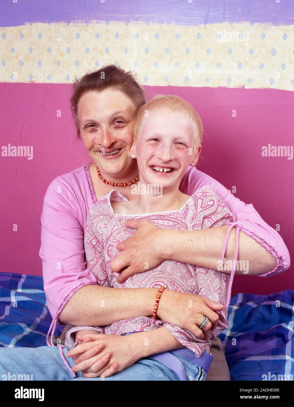 Ectodermal dysplasia. Mother and child with Ectrodactyly, Ectodermal ...