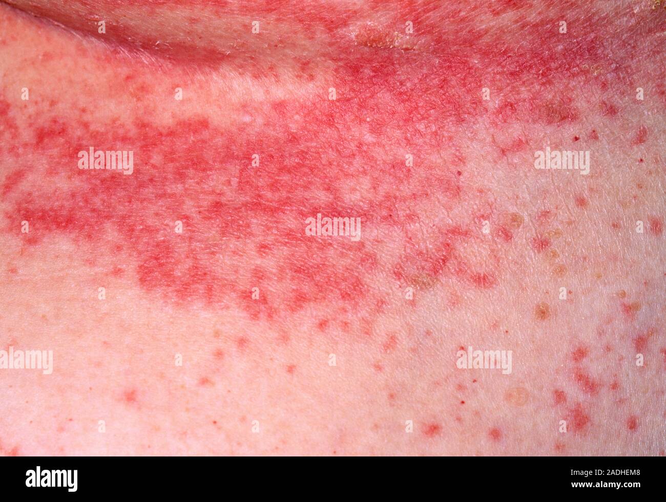 Seborrheic eczema on the skin of a 60-year-old woman. Seborrheic eczema ...