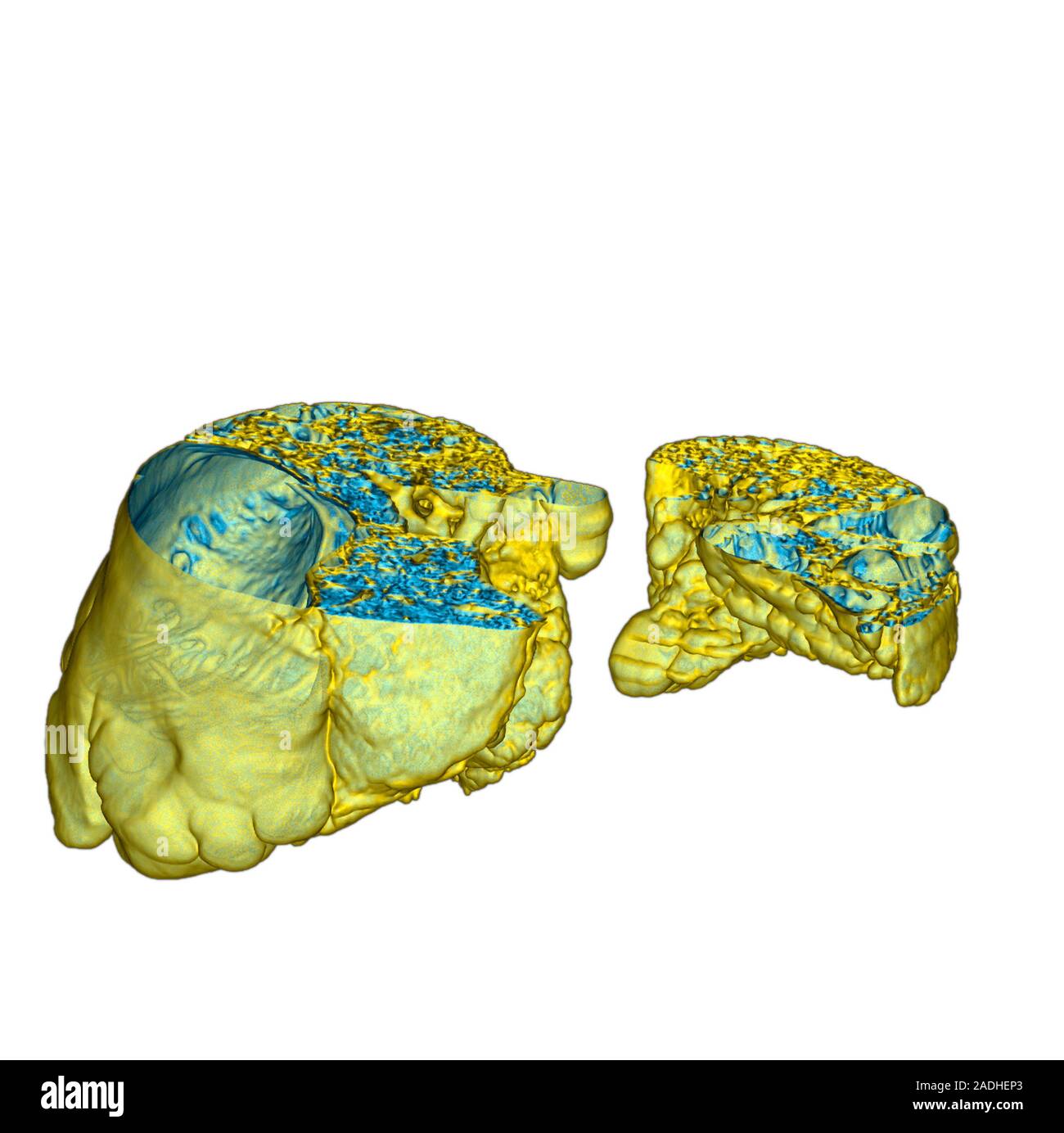Emphysema Coloured 3 D Computed Tomography Ct Scan Of The Lower