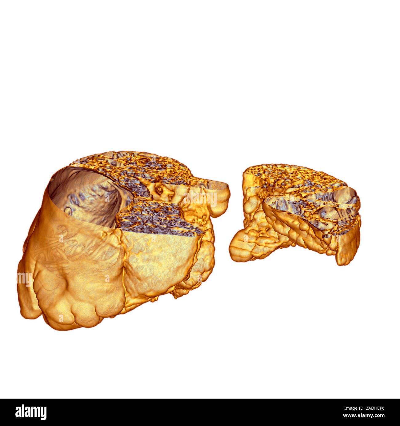 Emphysema. Coloured 3-D computed tomography (CT) scan of the lower ...