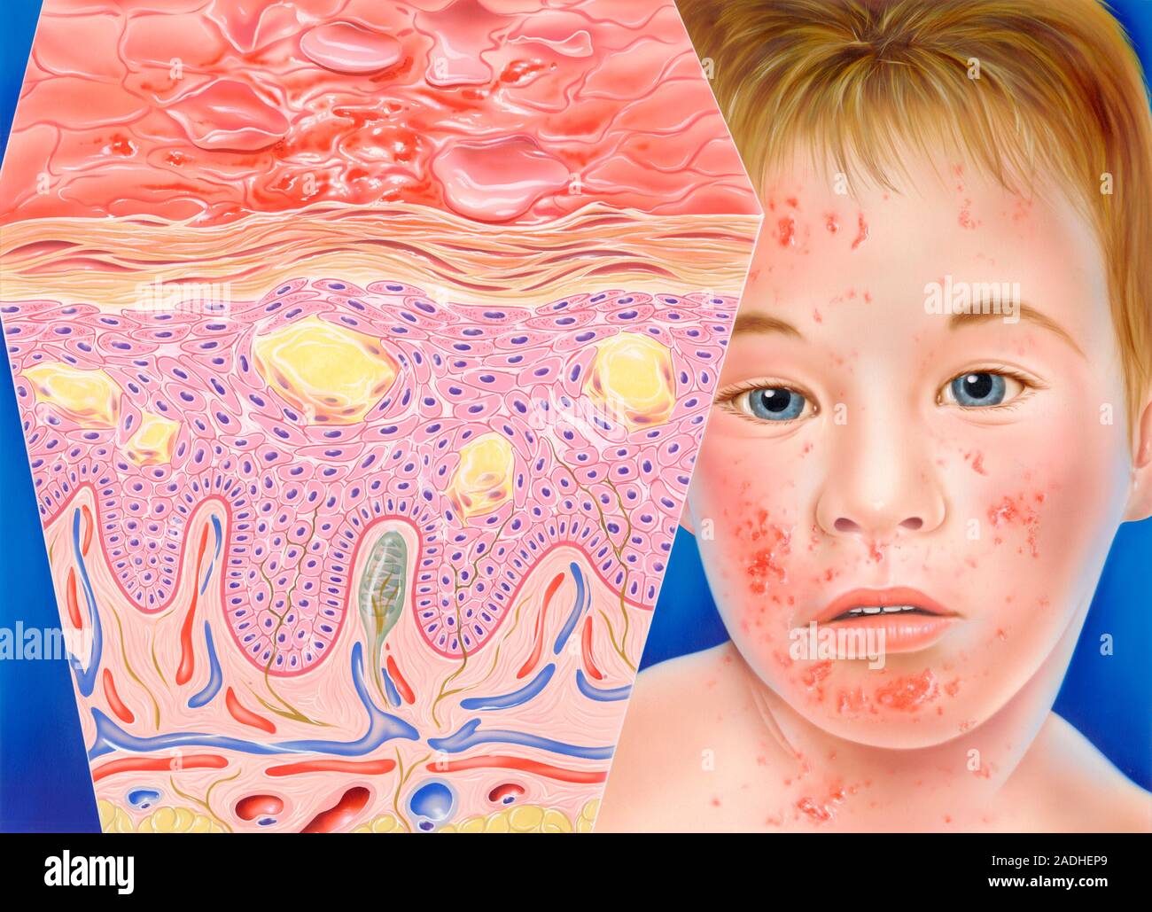 Eczema. Artwork of a section through the epidermis of human skin ...
