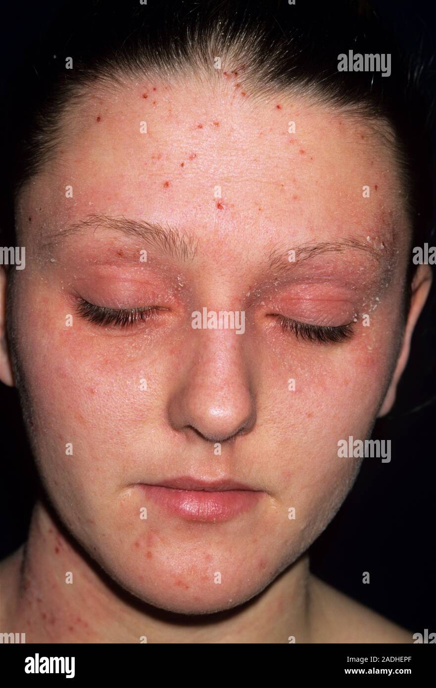 Eczema rash on the face of a 17 year old girl. Eczema is inflammation ...