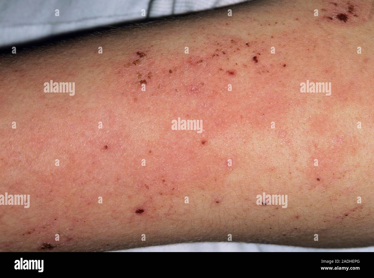 Eczema rash on the arm of a 17 year old girl. Eczema is inflammation of ...
