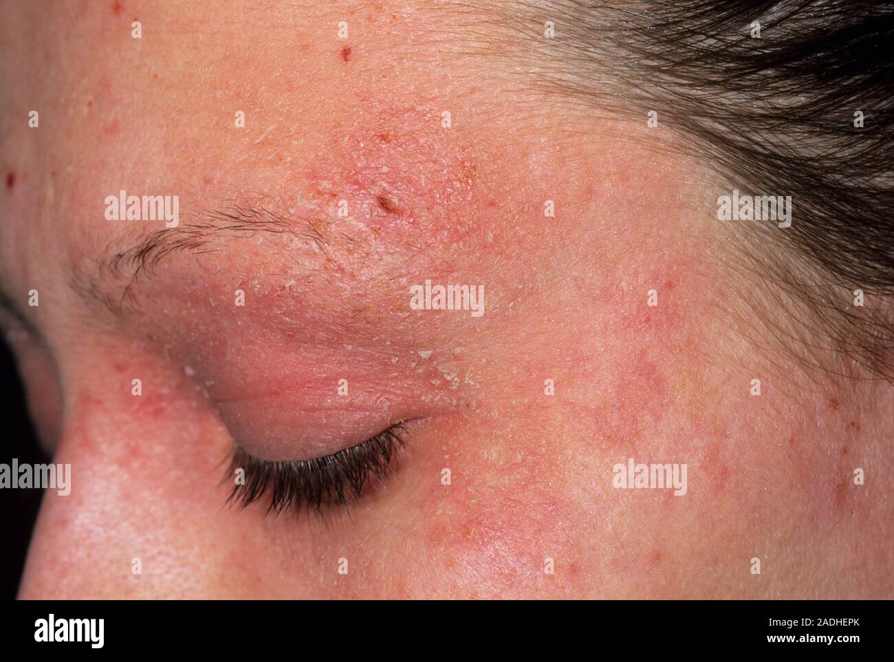 Eczema rash on the face of a 17 year old girl. Eczema is inflammation ...