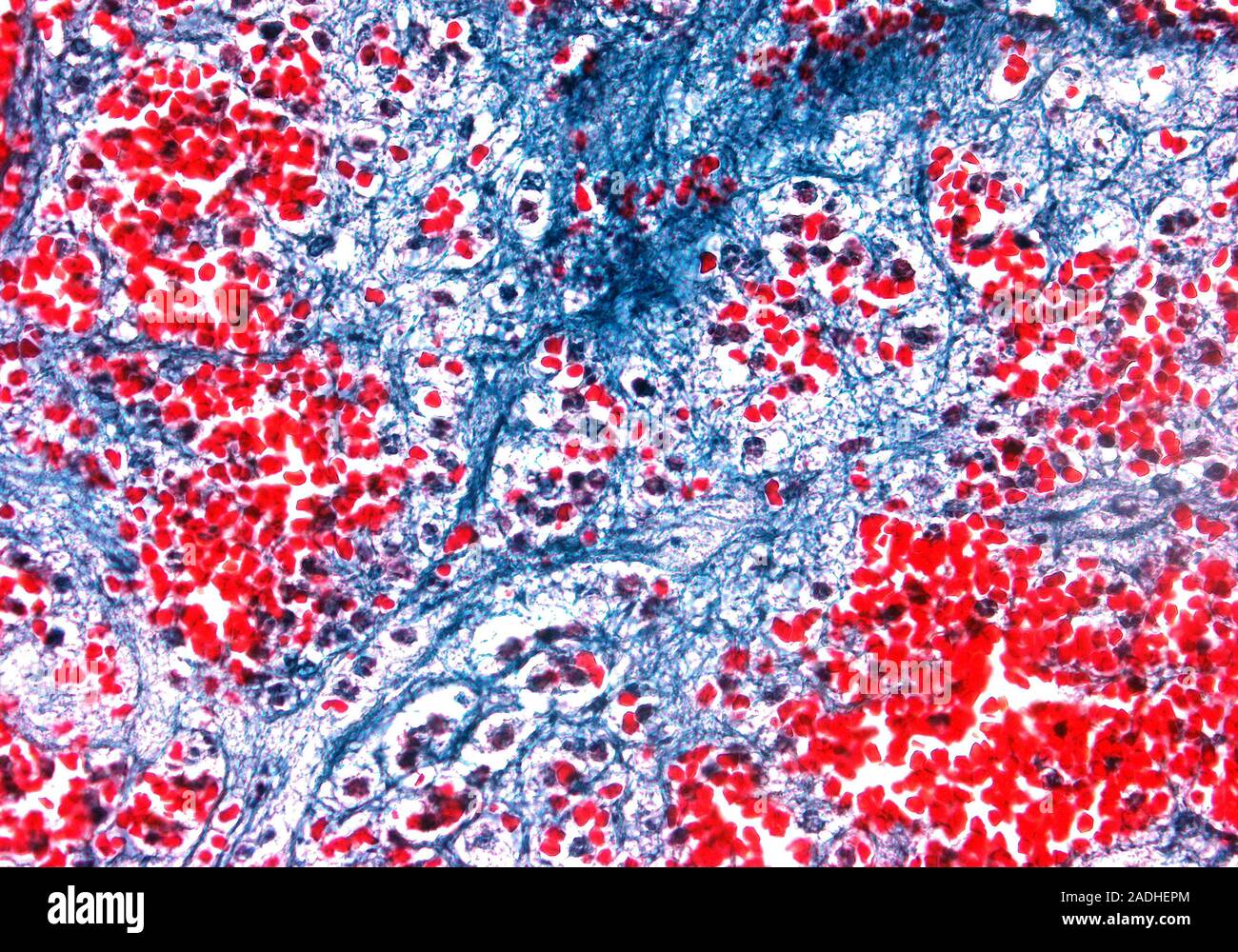 Internal bleeding in lung tissue due to pulmonary emphysema, light ...