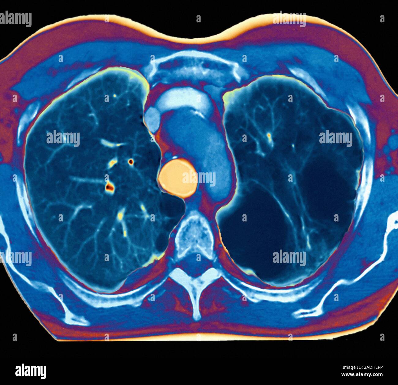 Emphysema Coloured Computed Tomography Ct Scan Of An Axial Section Through The Lungs Of A 60