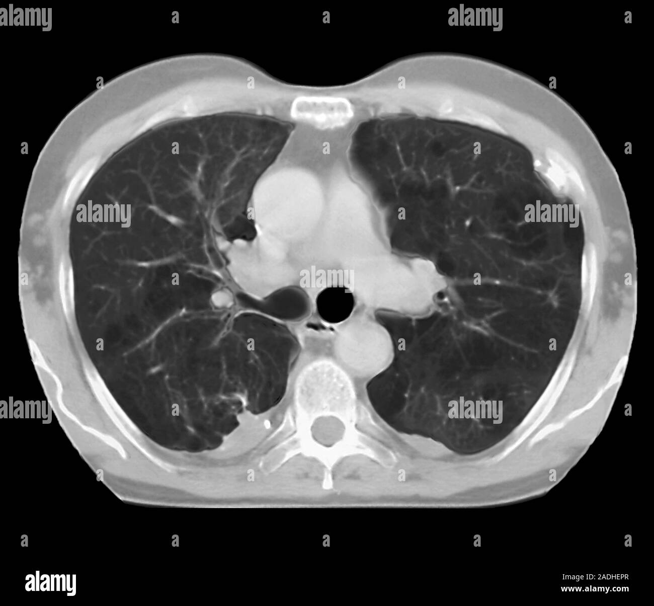 Emphysema. Computed tomography (CT) scan of an axial section through ...