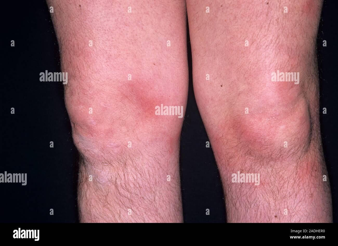 Swollen leg. Erythema nodosum (red swelling) on the lower leg of a 35 ...
