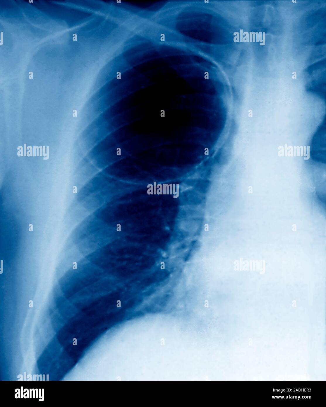 Emphysema. X-ray of the right lung of a patient with bullous emphysema ...