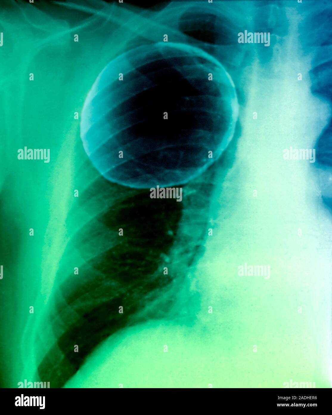 Emphysema. Coloured X-ray of the right lung of a patient with bullous ...