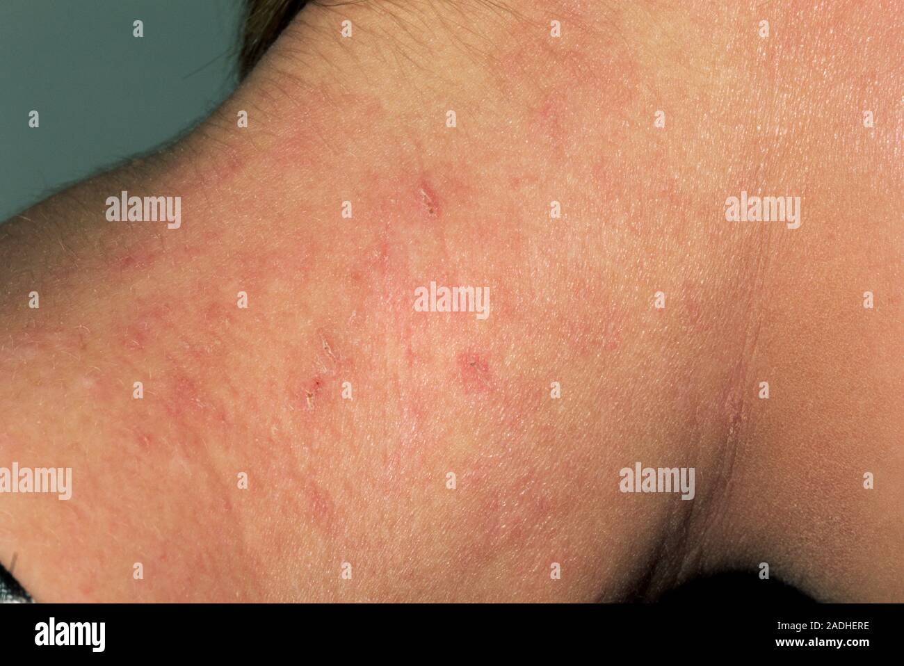 Eczema following treatment. Eczema on the neck of an 18-year-old woman ...