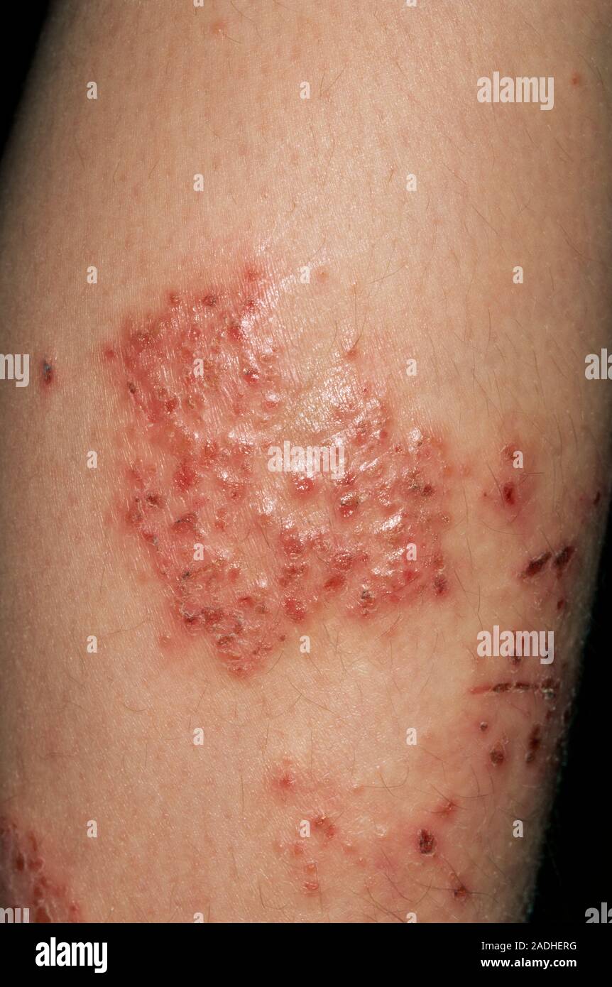 Infected eczema on the leg of a nine-year-old boy. This condition is an ...