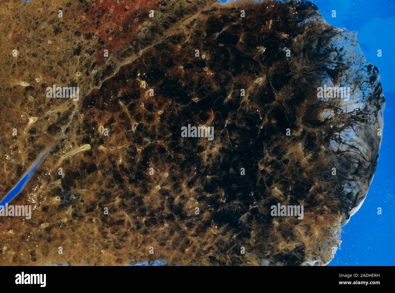 Emphysema. Gross specimen of part of a lung with emphysema. Emphysema ...