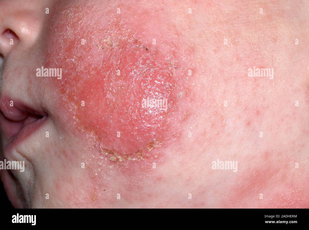 Infected eczema. Image 2 of 4. Infected eczema on the face of a 4-month ...