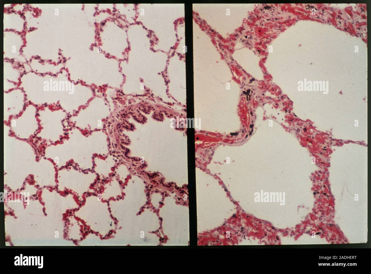 Emphysema and normal lung tissue, light micrograph. In normal lung ...