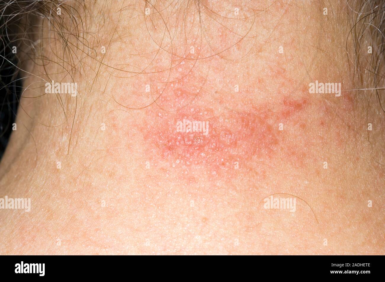 Eczema on the back of the neck of a 59 year old woman. Eczema is an ...