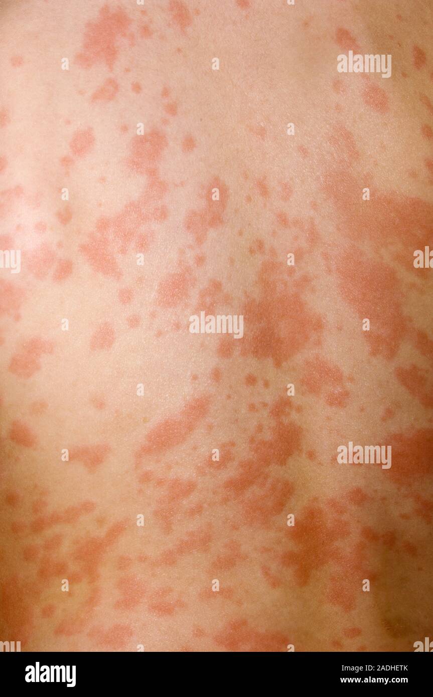 MODEL RELEASED. Erythema multiforme rash on a 2 year old boy's torso ...