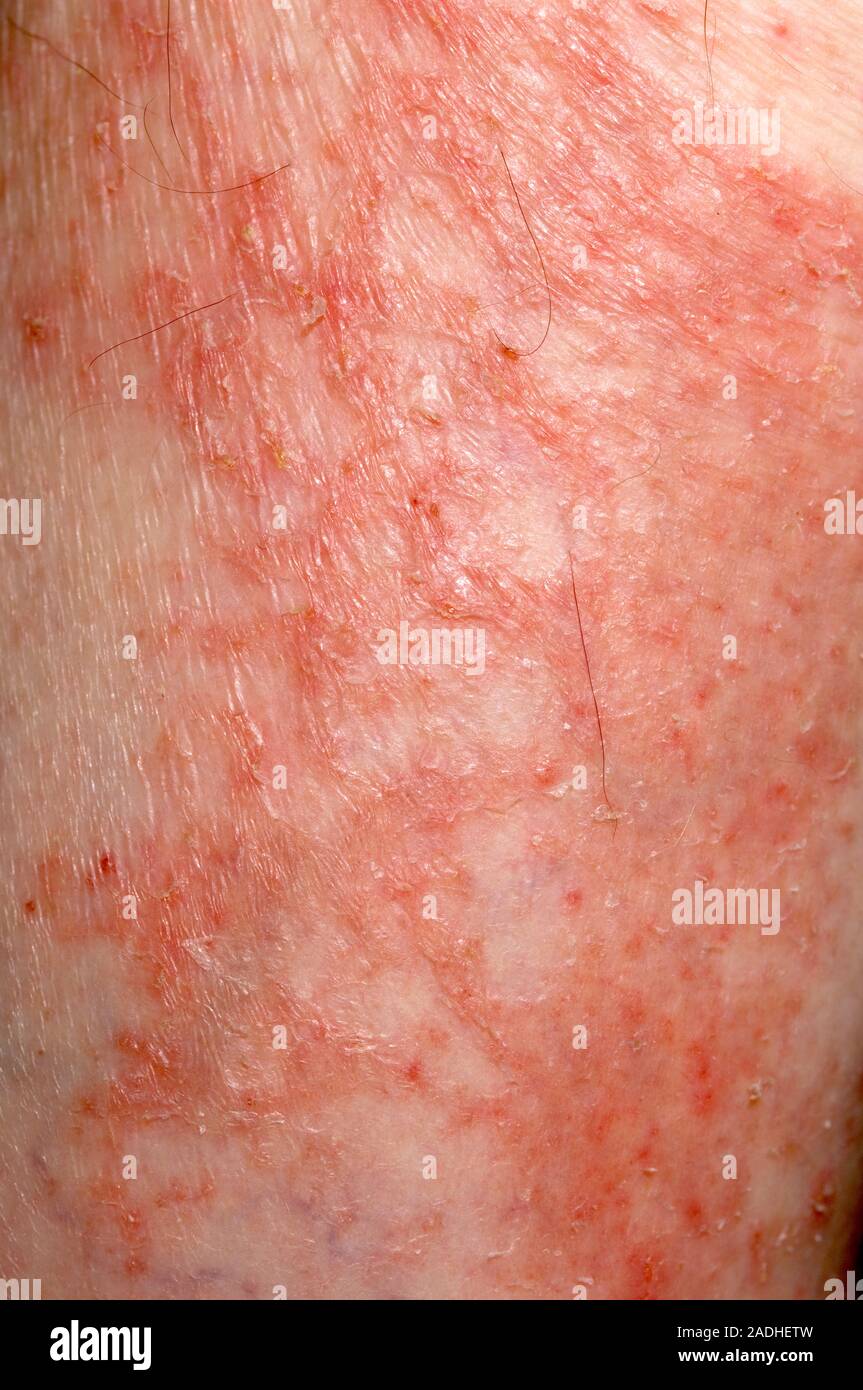 MODEL RELEASED. Eczema on an 84 year old man's skin. Eczema is an ...