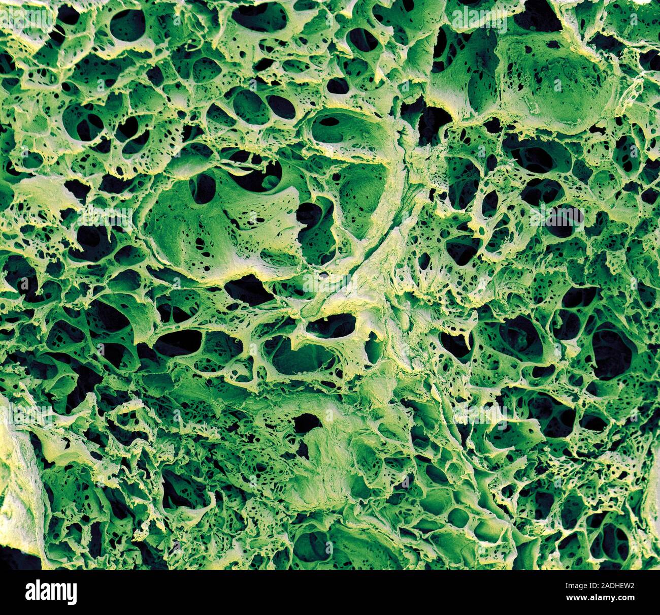 Emphysema. Coloured scanning electron micrograph (SEM) of human lung ...