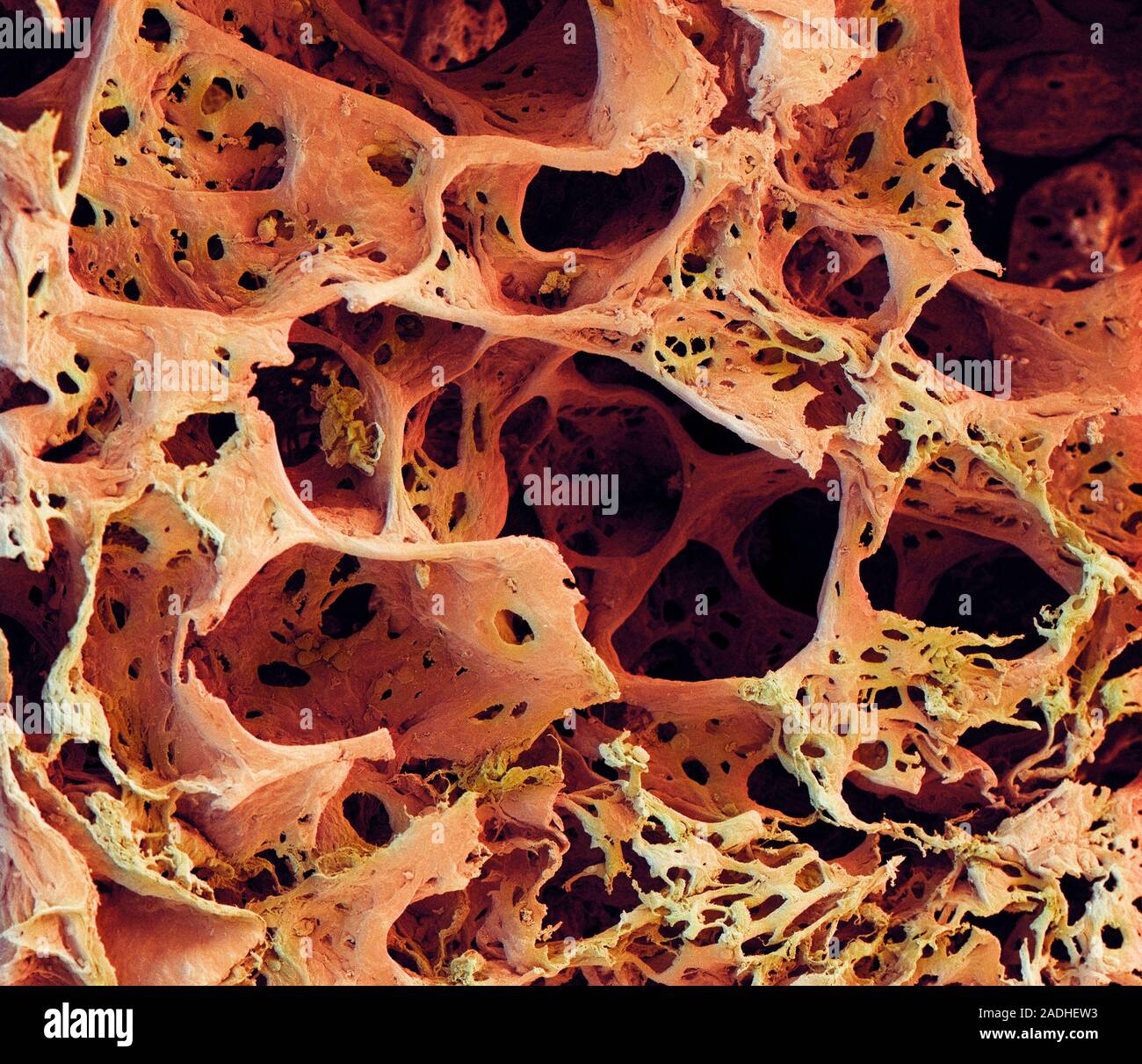 Emphysema. Coloured scanning electron micrograph (SEM) of human lung ...