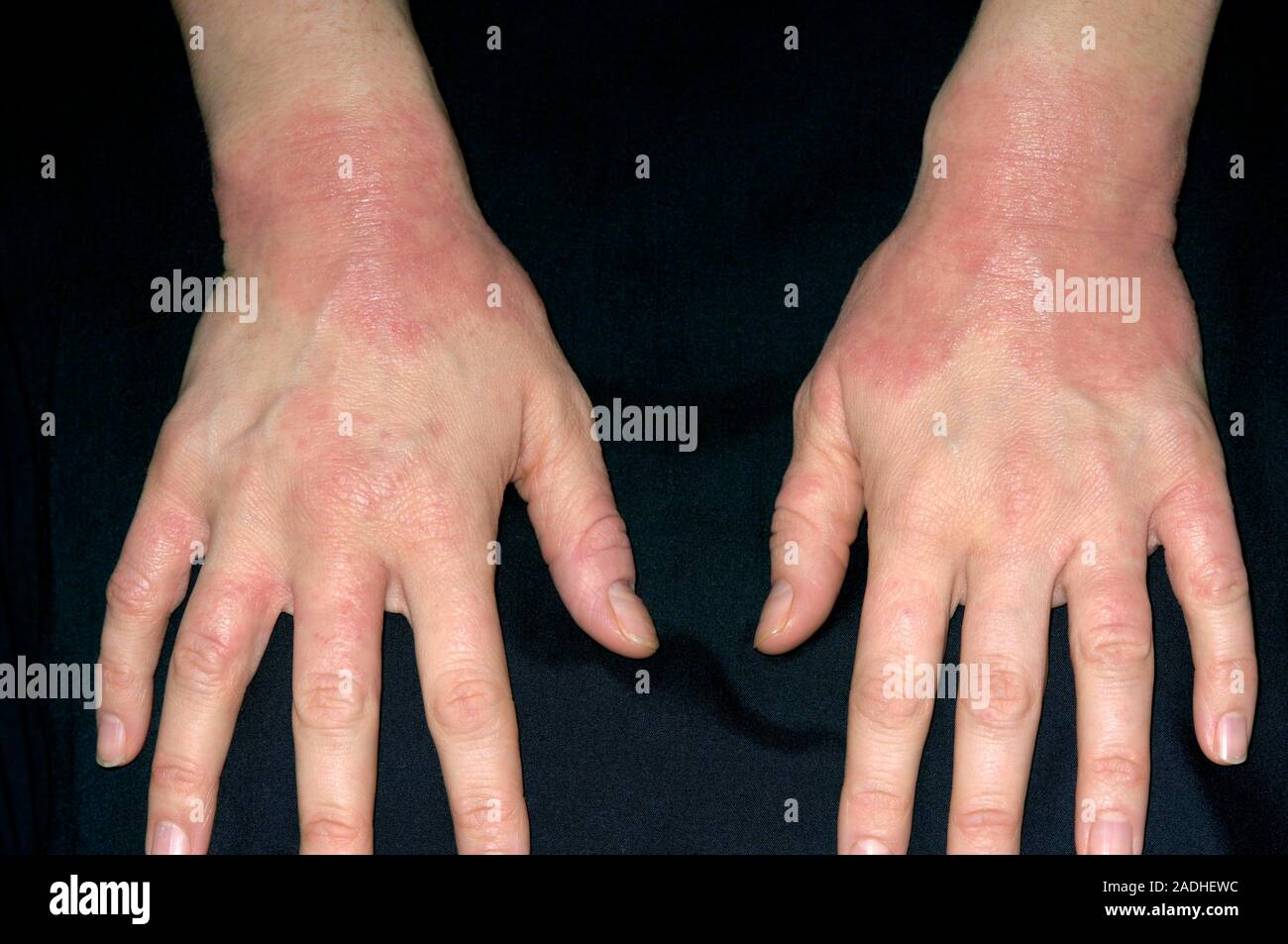 Eczema (red patches) affecting the skin on a 36-year-old woman's wrists ...